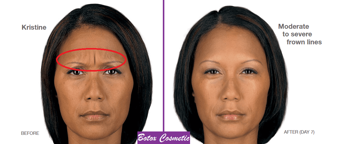 Dangerous Side Effects Of Botox